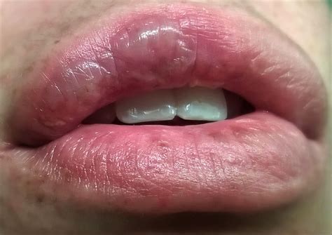 Why Do I Keep Getting Blisters On The Inside Of My Lip At James