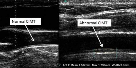Cimt Carotid Ultrasound Health Suite 110 Direct Primary Care