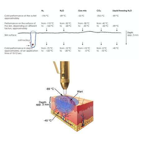 Different Cryosurgery Devices And Their Benefits