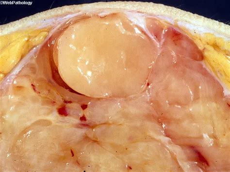 Phyllodes Tumor Low Grade