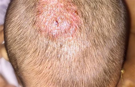 Tinea Capitis The Dermatology Digest