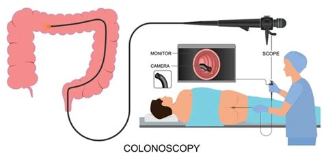 What Diseases Can Be Detected By A Colonoscopy Colowell America Proctology And Aesthetics Care