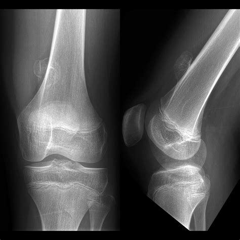 Osteochondroma X Ray Surgical Treatment On Subungual Osteochondromas