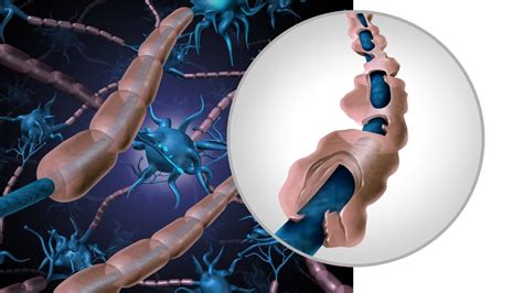 Multiple Sclerosis Treatment The Benefits Of Physiotherapy