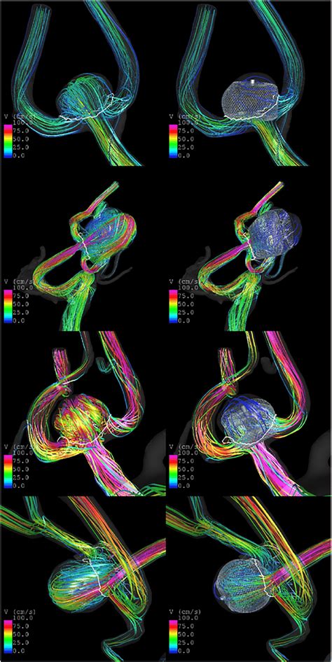 Flows Before Left Column And After Right Column Implantation Of Download Scientific Diagram