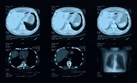 Cardiac Left Ventricle Segmentation By Rsip Vision