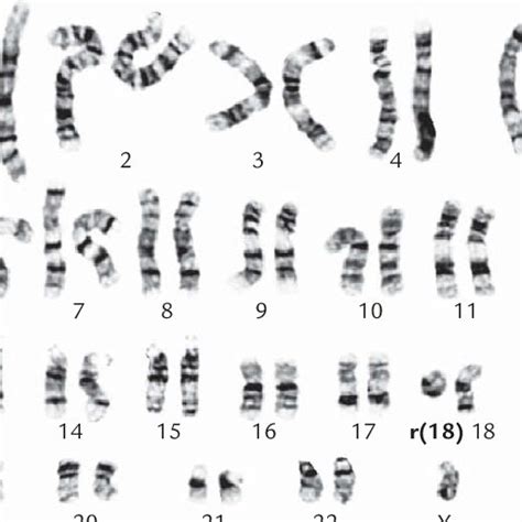 Pdf Mosaic Ring Chromosome 18 Ring Chromosome 18 Duplication