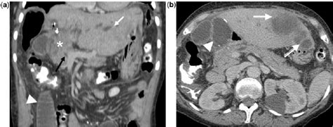 A 69 Year Old Woman With A History Of Extended Right Hepatectomy Download Scientific Diagram