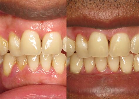 Periodontal Disease Before And After Pictures