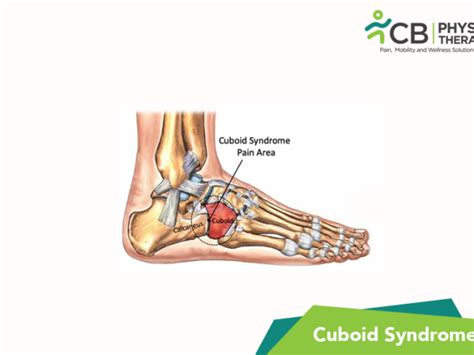 What Is Cuboid Syndrome Symptoms Causes Diagnosis And Physiotherapy Treatment Of Cuboid