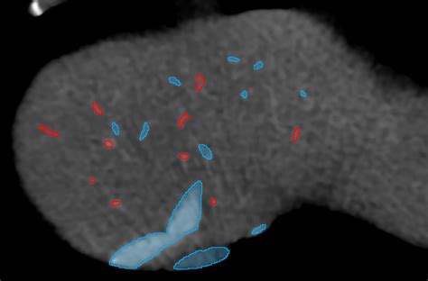 Duplicated Segmentation Error Support 3d Slicer Community