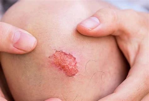 Kenali Gejala Dan Penyebab Dekubitus Luka Akibat Penekanan Kulit