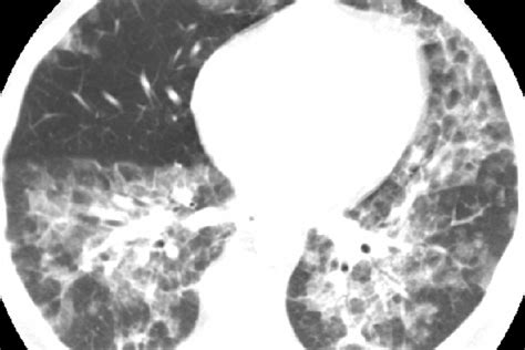 Open Source Group To Aid Ild Care Through Digital Imaging Ml Health