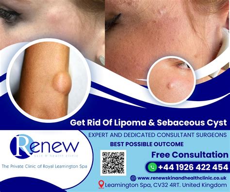 Renew Lipoma And Sebaceous Cyst Removal Do You Have A Lump Or Bump That