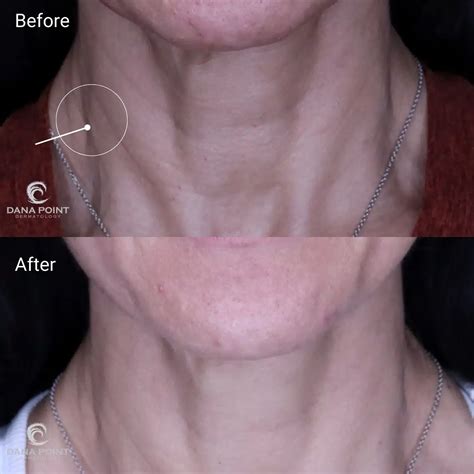 Microneedling Radiofrequency Skin Tightening Before And After