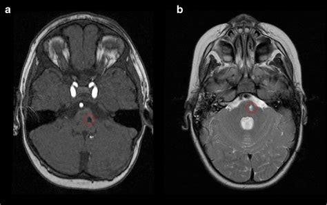 Axial 3d Tof Time Of Flight Spgr Spoiled Gradient Recalled Echo Mri
