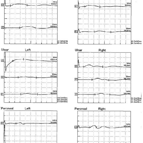 Electroneurography Revealed Proximal Conduction Blocks Detected By The