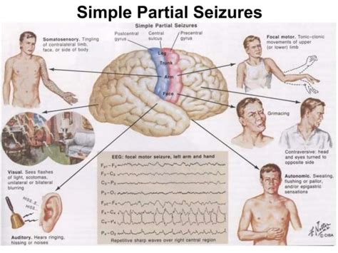 Diagrams Eeg Epilepsy Ppt Brain And Nervous System Disorders Diseases And Conditions