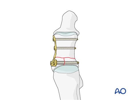 Orif Plate For Complete Articular Fractures Of The Proximal Hallux