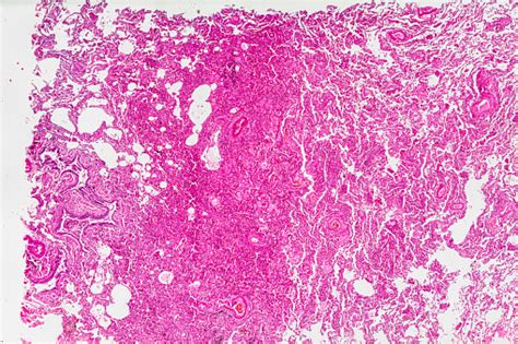 Chronic Congestion Of Lung Under Light Microscopy Zoom In Different