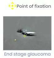 What Is Glaucoma Belgian Glaucoma Society