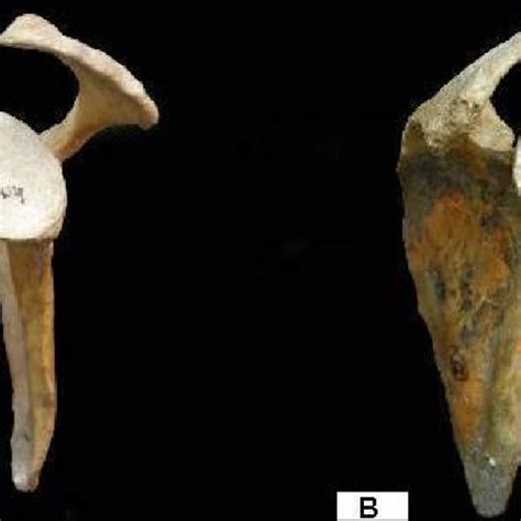 A Lateral View Of Right Scapula Demonstrating Type I Flat Acromion