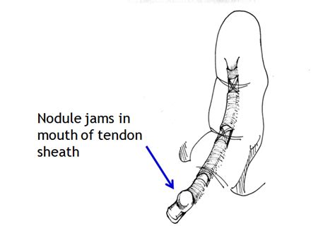 Trigger Finger Thumb The British Society For Surgery Of The Hand