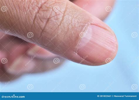 Vertical Ridges On Fingernails Treatment Are You Noticing Vertical