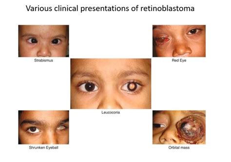 Retinoblastoma Symptoms Chect Uk On X Its National Eye Health Week