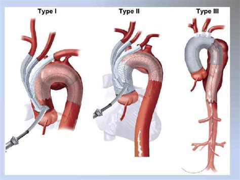 Some Alternative Procedures For An Aortic Arch Aneurysm
