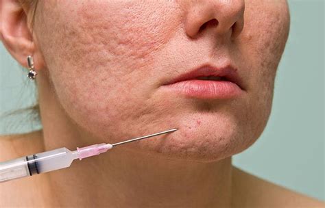 How To Get Rid Of Pockmarks Is It Possible To Get Rid Of Them