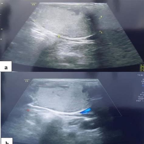 Clinical Picture Of Dermoid After Removal Download Scientific Diagram