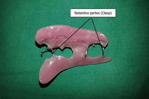 Mandibular Guide Flange Prosthesis Pdf