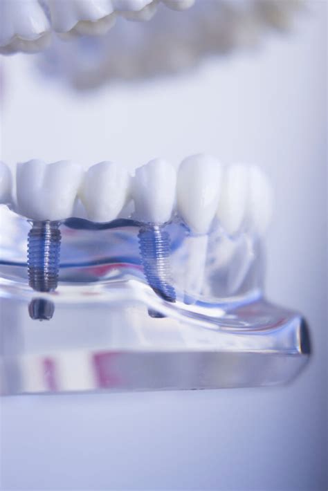 Implants Offer Natural Looking Tooth Replacement Rochester Mn