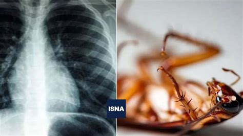 خارج کردن سوسک زنده ۴ سانتی‌متری از ریه یک مرد ۵۵ ساله همشهری آنلاین