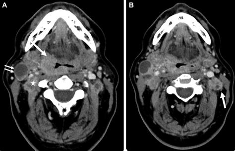 Lymph Node Dissection Radiology Key