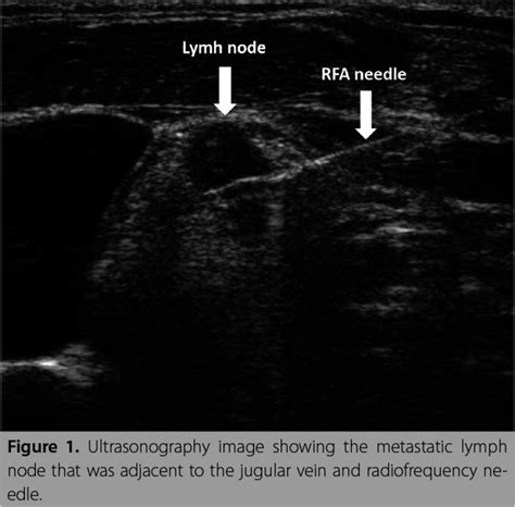 Radiofrequency Ablation Of Metastatic Lymph Nodes In A Patient