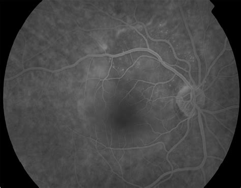 Ffa Of The Re Late Frames Showing Hyperfluorescence Of The Mass Due