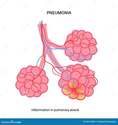 Pneumonia Infection Concept Stock Vector Illustration Of System