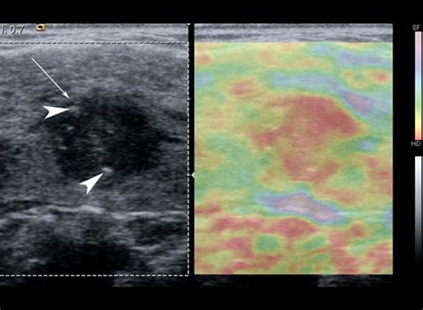 Thyroid Ultrasound Elastography Does Nodule Stiffness Predict Malignancy Ent And Audiology News