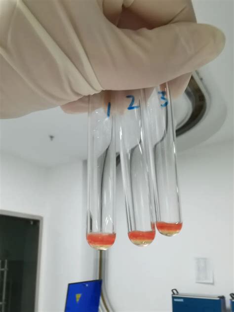 疑难abo血型鉴定之初诊多发性骨髓瘤处理策略（附案例分享）患者多发性骨髓瘤血型试管 健康界