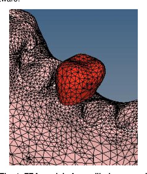 Figure 1 From Effect Of Restorative Crown Of Different Cuspal Inclination And Occlusal Contact