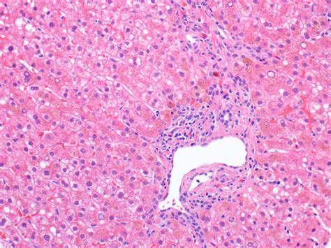 Pathology Outlines Chronic Hepatitis