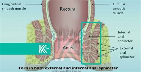 Torn Sphincter Muscle Repair