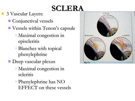 Uvea And Sclera Ppt