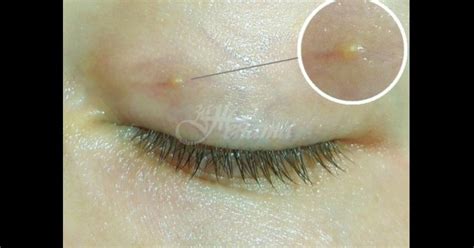 Имате ли такива бели топчета по клепачите Ето каква опасност крият и как безопасно да ги