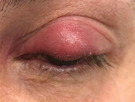 Sore Lump On Eyelid Eyelid Bumps Symptoms Wqwzk