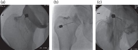 Air As Contrast Media For Hip Arthrogram The Annals Of The Royal