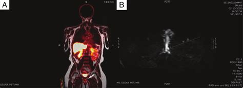 A Coronal 18F PSMA PET MRI Focal PSMA Captation In The Base Of The Download Scientific
