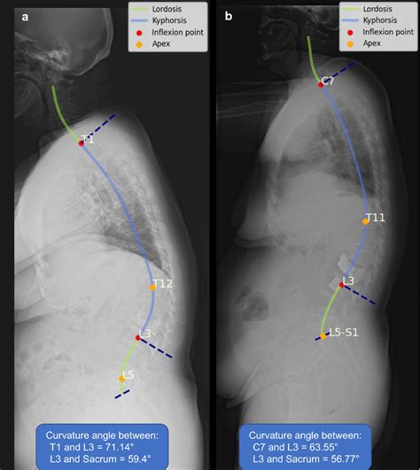 A A Year Old Female Patient With An Osteoporotic Compression Download Scientific Diagram